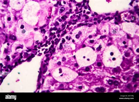Histopathology Of Acute Hepatitis Light Micrograph Photo Under