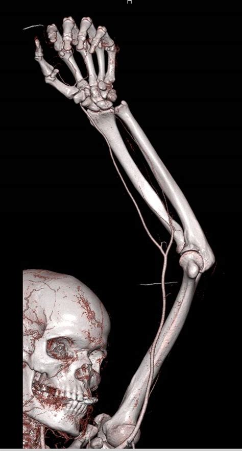 Ct Anatomy Of Forearm At Janet Bailey Blog