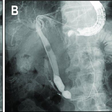 Per Oral Cholangioscopy Assisted Electrohydraulic Lithotripsy EHL Download Scientific