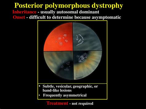 Ppt Corneal Dystrophies Powerpoint Presentation Free Download Id 735456
