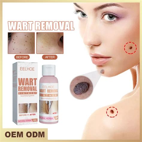 Filiform Wart
