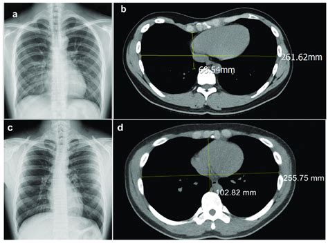 Pectus Excavatum Is Diagnosed By Haller Index 3 25 Calculation Of Download Scientific Diagram