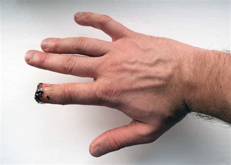 Finger Replantation Teachmesurgery