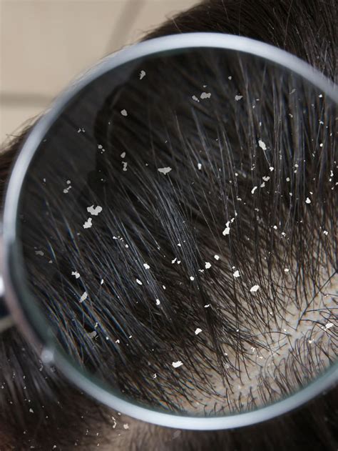 Tips To Deal With Dandruff The Indian Express