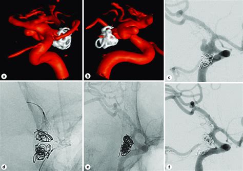 Previously Coiled Ruptured Wide Neck Dysplastic Pcom Aneurysm A B Download Scientific