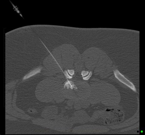 Ct Guided Nerve Root Injection Melbourne Radiology