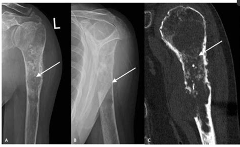 Chondroid Tumors Sports Medicine Review