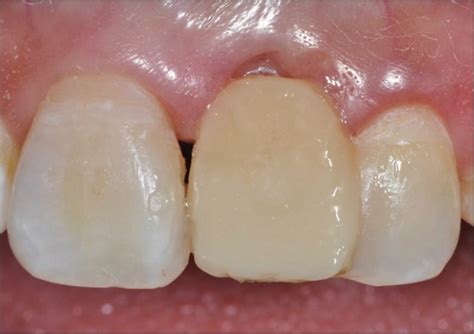 Prefabricated Frc Fixed Partial Prosthesis Was Bonded To The Abutment Download Scientific Diagram