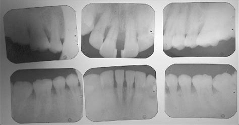 Radiographic Examination Showed Generalized Moderate Horizontal Bone