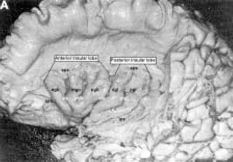 Photograph Showing Typical Five Lobed Human Insular Cortex With The Download Scientific Diagram