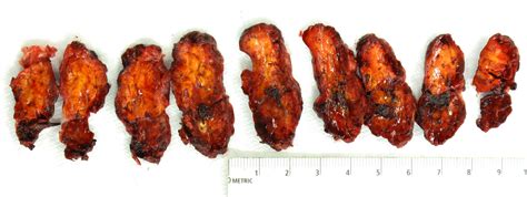 Pathology Outlines Hemangioblastoma
