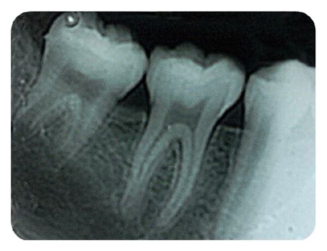 Treatment Of Ectopic Mandibular Second Permanent Molar With Elastic
