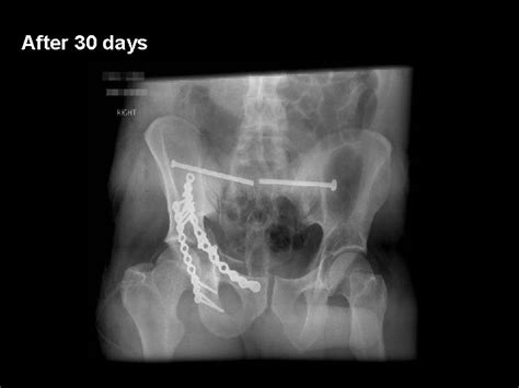 Polytrauma Patient With A Pelvic Fracture Case 1