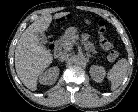 Ct Search Pattern Lungs