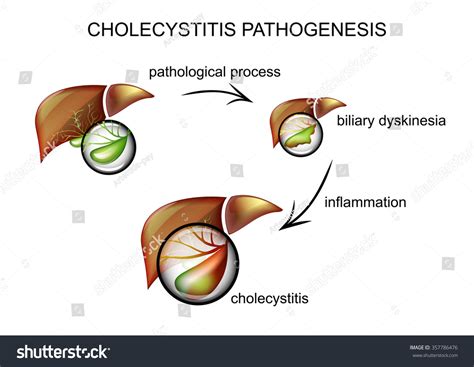 Illustration Gallbladder Inflammation Pathogenesis Disease Stock Vector