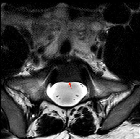 Dural Ectasia Radsource