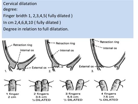 How To Mere Cervix Dilation At Home Homemade Ftempo