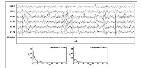 Cyclic Alternating Pattern A1 Subtypes During S4 Characterized By