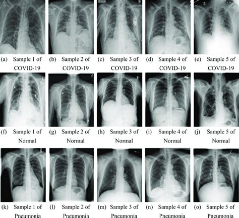 Chest X Ray 2 Views Cpt Code 2020 At Leo Rey Blog
