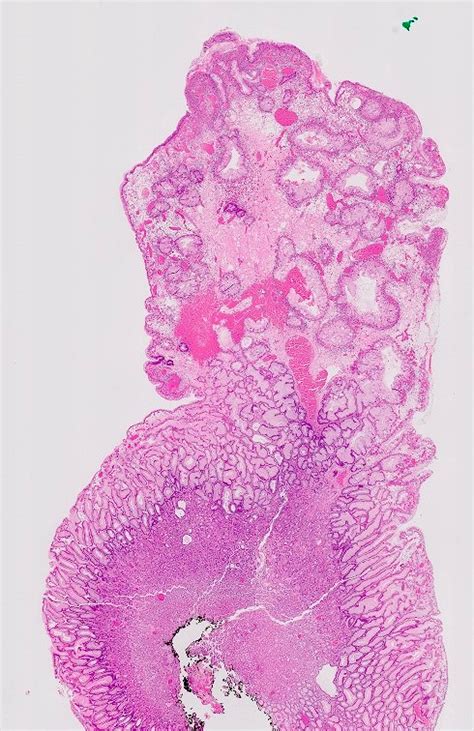 Hyperplastic Polyp Pathology Outlines Clinical Pathology Intestinal