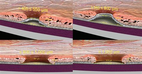 Macular Hole Closure A New Classification Retina Today