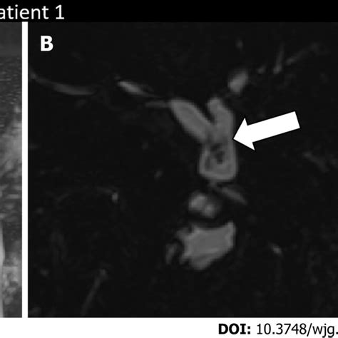 Biliary Sludge And Biliary Cast A Patient With Biliary Sludge And
