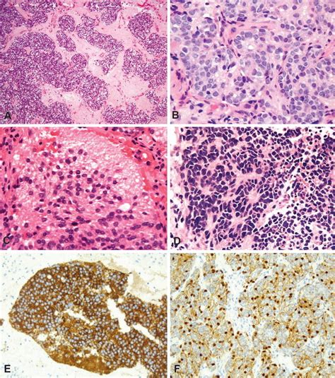 Low Grade Onb Composed Of Individual And Confluent Nests Of Small Round Download Scientific