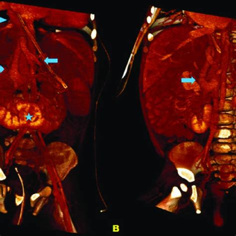 Electrocardiogram Showing Ectopic Atrial Rhythm With Right Ventricular Download Scientific