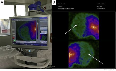 Portable Gamma Camera For The Diagnosis Of Brain Death Diagnosis