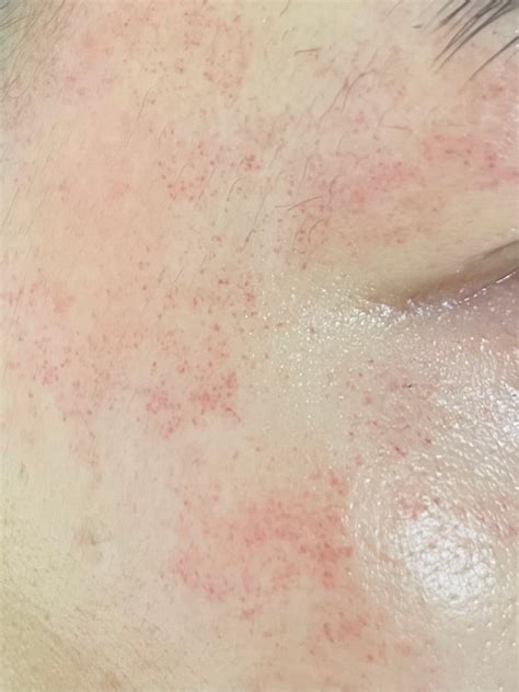 얼굴에 붉은 반점이 갑자기 생겼어요 지식in