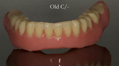 Complete Denture Class Ii Div 2 Deep Overbite Newsletter 39 Finlay Sutton
