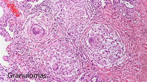 Sarcoidosis Histology