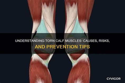 Understanding Torn Calf Muscles Causes Risks And Prevention Tips