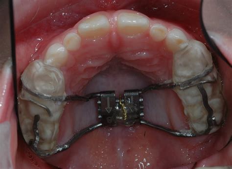Orthodontic Corner Bone Anchored Maxillary Protraction Of Growing
