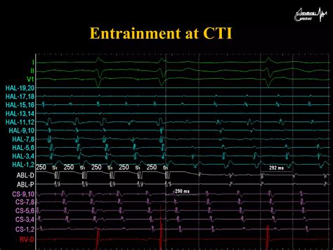 Ablation Of Atypical Flutter Pptx