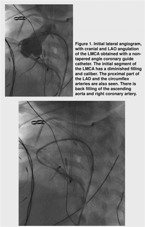 Lateral Angiogram Following Percutaneous Coronary Angioplasty With Download Scientific Diagram