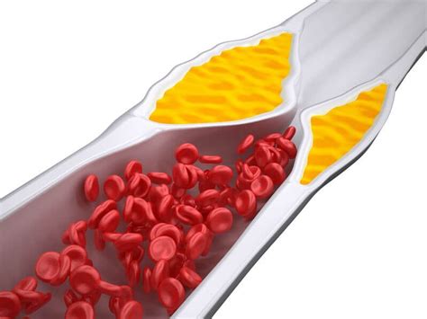 What Is Considered A Normal Cholesterol Level