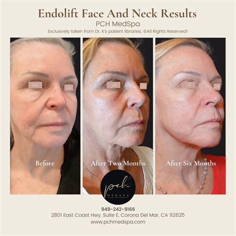 Endolift Laser Treatment Orang County Newport Beach Ca