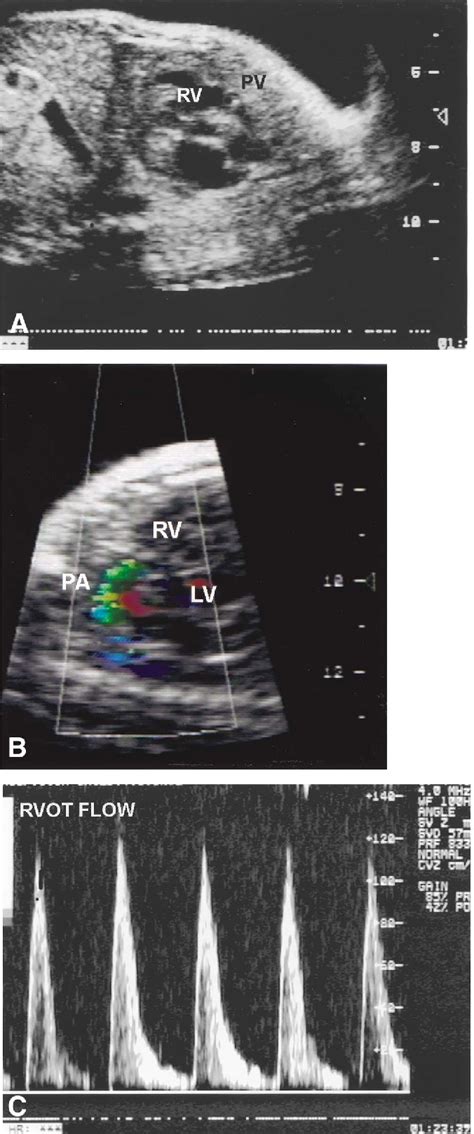 Biventricular Hypertrophy Semantic Scholar