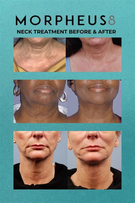 Best 12 Dermal Fillers Types Benefits Uses Side Effects And More