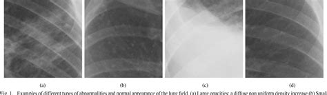 Figure 1 From Automatic Detection Of Tuberculosis In Chest Radiographs Using A Combination Of