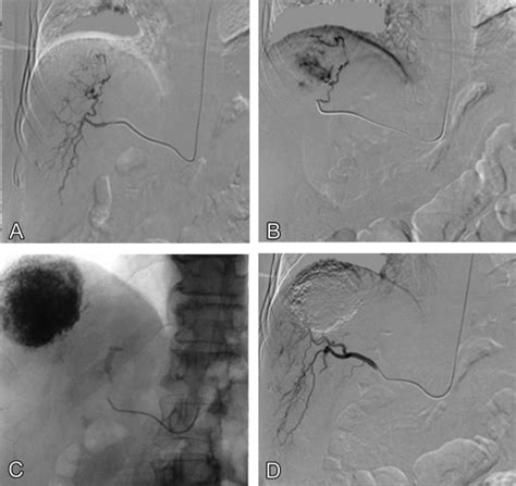 Transradial Chemoembolization Using A 4f 125cm Bern Catheter Impress Download Scientific