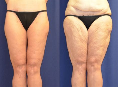Coolsculpting Vs Lipo