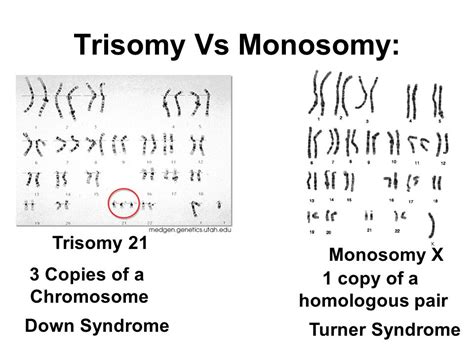 Monosomy 21