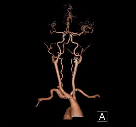 67 Years Female Cardioembolic Stroke The Adopted Plan Catheter Thrombectomy Stent