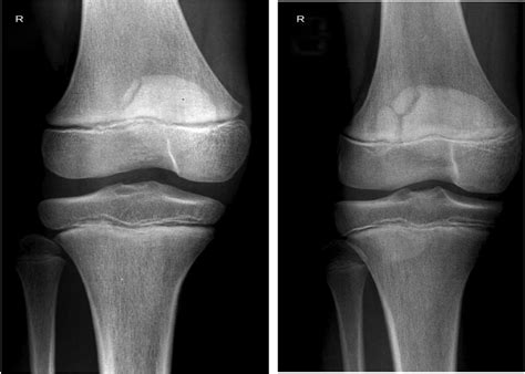 Tripartite Patella Late Appearance Of A Third Ossification