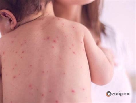 Улаанбурхан өвчний батлагдсан тохиолдол 1891 бүртгэгдлээ