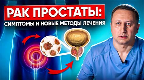 Рак простаты у мужчин: симптомы и лечение