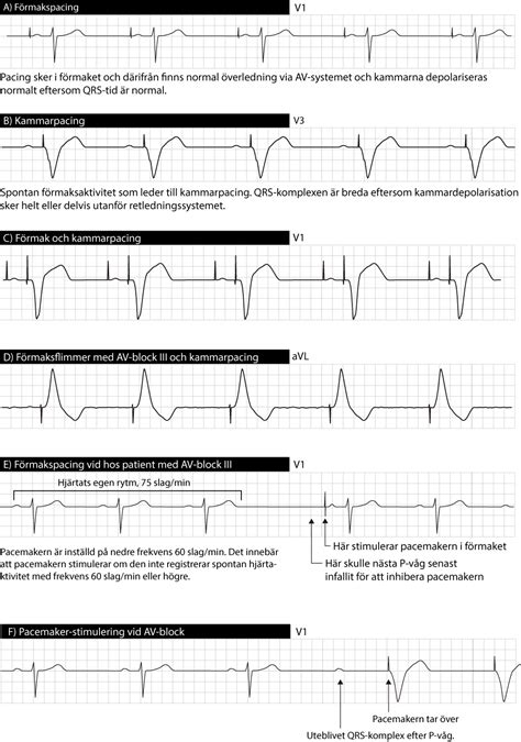 Pacemaker Ekg 1 EKG Nu