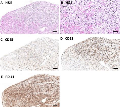 Case Report Of Fatal Immune Mediated Myocarditis Following Treatment With Davoceticept Alpn 202